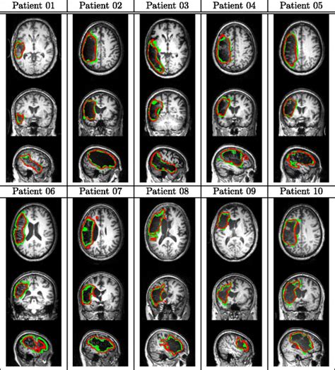 Sample Results Of Lesion Detection On Selected 2d Slices Of Different Download Scientific
