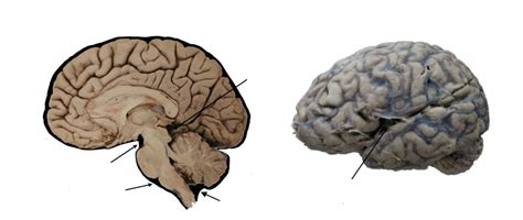 Subarachnoid Cisterns Diagram Quizlet