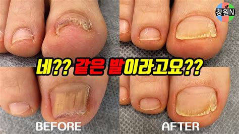 창원n 창원 상남동 무좀 창원 상남동 내성발톱 상남동 네일 상남동 페디 상남동 문제성 발톱 상남동 문제성 손톱 Youtube