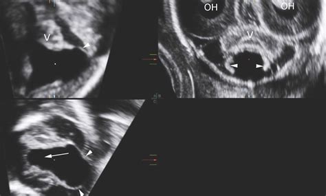 Abnormal Or Delayed Development Of The Posterior Membranous Area Of The