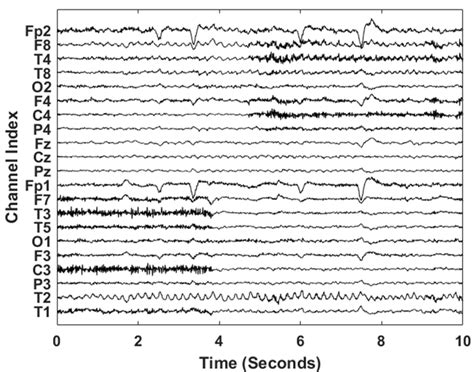 10 s ictal eeg contaminated with eye blinks and muscle artifacts