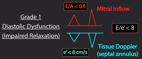 How To Measure And Grade Diastolic Dysfunction Using Echocardiography Diastology Pocus 101