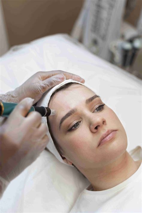 Microneedling For Acne Scars Clairéderma