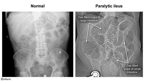 Small Bowel Obstruction Gastroenterology Uworld Medical Library