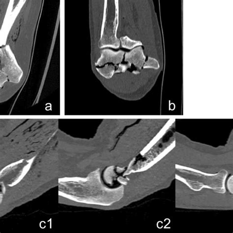 Exemplary Ct Cross Sections Of A Typical Humerus Fracture Pattern