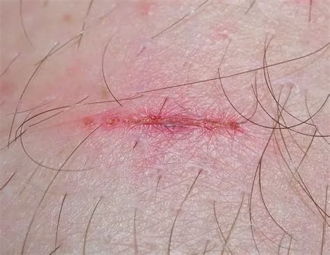 Kode Icd 10 Vulnus Laceratum Tangan