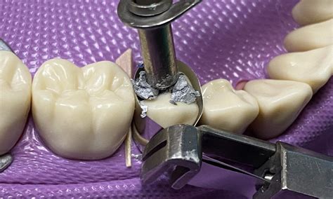 Class Ii Amalgam Restoration My Dental Key Restoration Dental Class