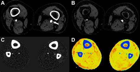 Dual Energy Run Off Cta On A Dual Layer Spectral Detector Ct Scanner Download Scientific