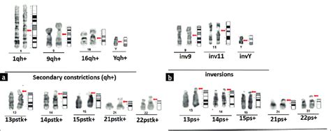partial karyotypes showing a b polymorphic variants in the
