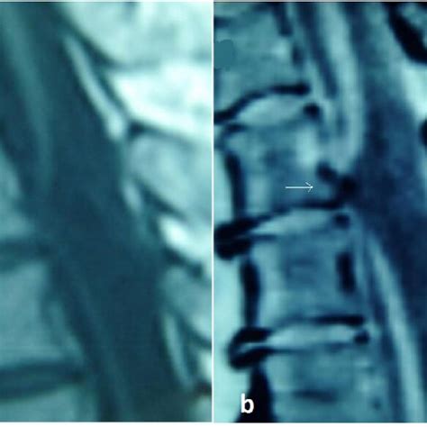 Preoperative Mri In Case 1 A Axial T2 Mri And B Sagittal T1 Mri