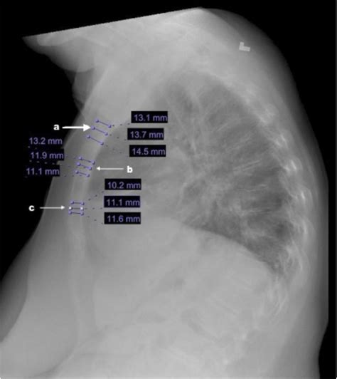 Sternal Bone Anatomy On Preoperative Imaging As An Independent Predictor Of Deep Sternal