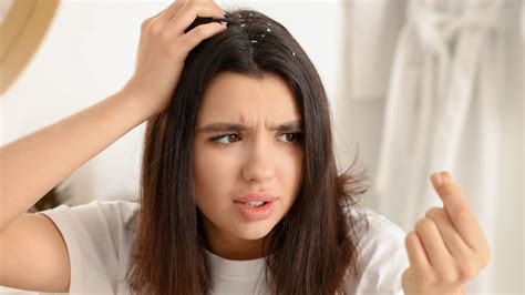 Winter Haircare 4 Easy Ways To Eliminate Dandruff From Your Scalp