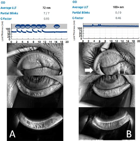 Figure 1 From Improvement Of Ocular Surface Disease By Lateral