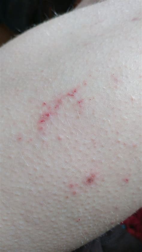 6 5 Weeks After Treatment Post Scabies R Scabies