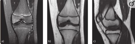 Knee Osteochondritis Dissecans Care Sports Medicine Review