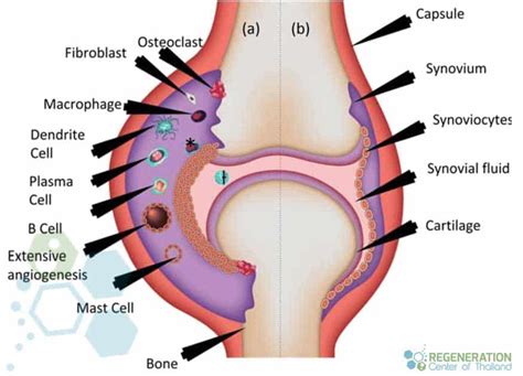 Immunomodulatory Effects Of Stem Cells For Rheumatoid Arthritis