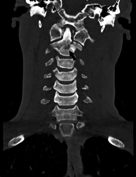 Coronal View Noncontrast Computed Tomography Showing A Type Iii