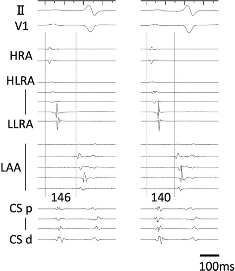 Figure 2 From High Density Activation Map Of Atrial Tachycardia Within Left Atrial Appendage