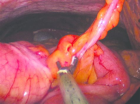 Appendix Divided From The Mesoappendix By Using Ultrasonic Ace Usual