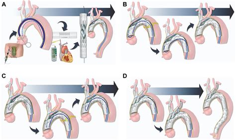 Total Transfemoral Percutaneous Endovascular Aortic Arch Repair Using 3