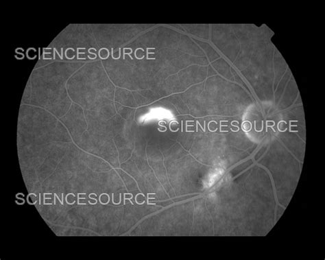 Fundus Fluorescein Angiography Central Serous Retinopathy