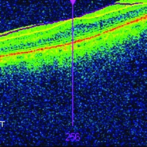 Segmentation On The Original Image Retinal Layers Are As Follows