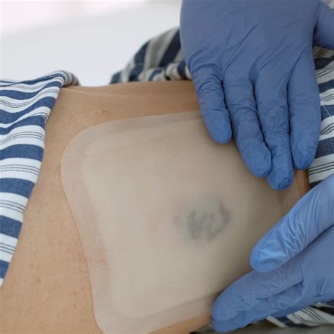 Hydrocolloid Dressing Conkote