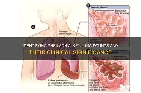 Identifying Pneumonia Key Lung Sounds And Their Clinical Significance
