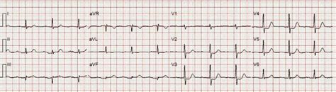 What Is The Infarct Artery What Does The Post Pci Ecg Show What Does