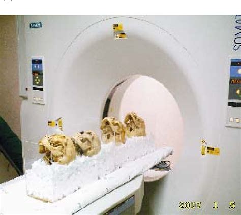 Figure 1 From Determination Of Average Contour Of Thais Skulls For Design Of Implants Semantic