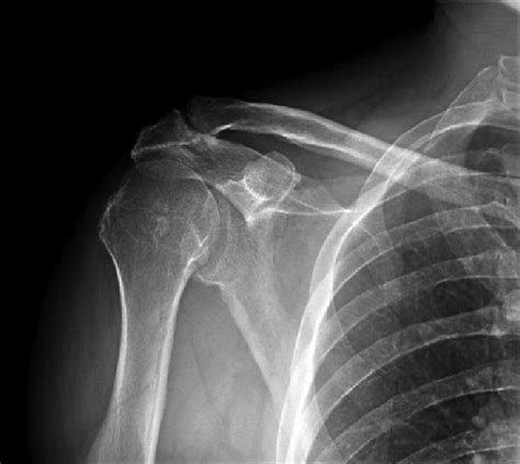 Rotator Cuff Tear Arthropathy Pathophysiology Imaging Characteristics