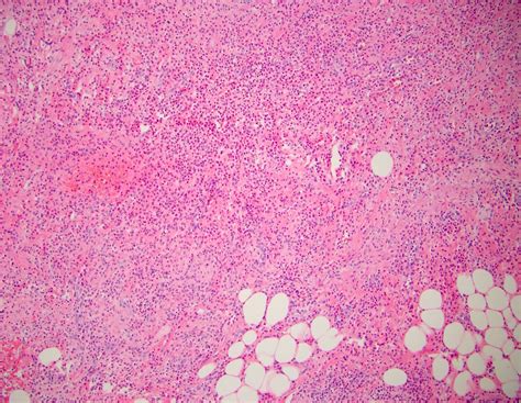 Pathology Outlines Fibrous Obliteration
