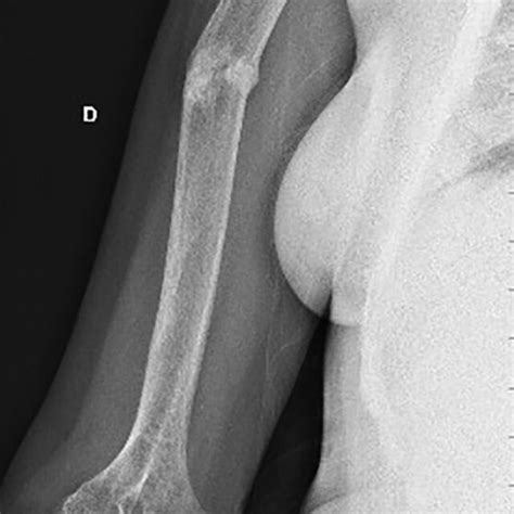 Right Side Humerus X‐rays Previous Pseudarthrosis Download