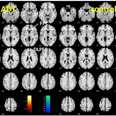 Tissue Probability Maps For A Gm B Wm And C Csf In The Living Mouse