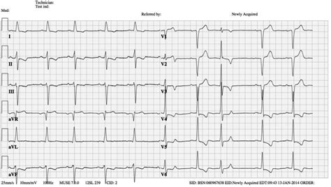 What Is The Origin Of The Ectopic Beat Pmc