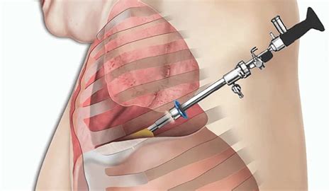 Thoracoscopy Doctor In Ahmedabad Chest Specialist