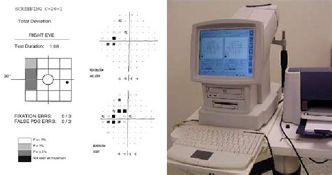 Fdt Visual Fields Scope Vision Care