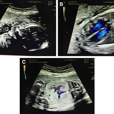 Intrauterine Ultrasound Phenotype Of The Fetus A Ultrasound Of The Download Scientific