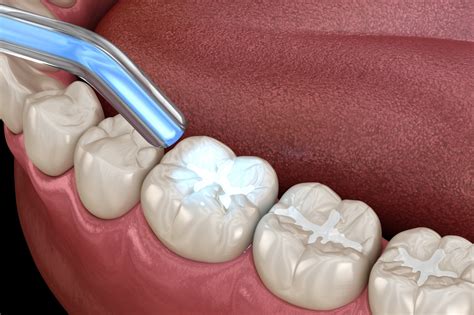 Restorative Dentistry Frequently Asked Questions