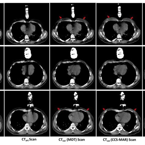 The Effects Of Metal Artifacts From Dental Hardware Are Highest With Download Scientific
