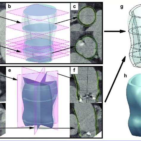 Stages Of Reconstruction Of The Aortic Root Model Using The Cad Method