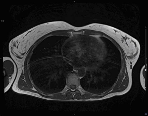 Desentrañando La Incisura Angularis
