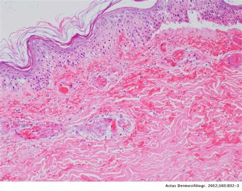Widespread Cutaneous Necrosis As The First Clinical Manifestation Of