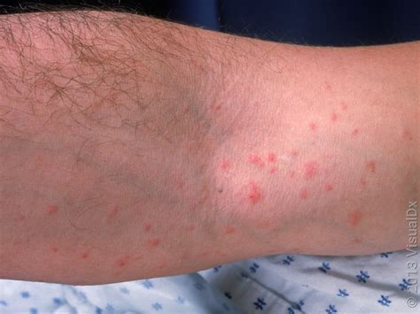 bed bug bites and hives difference at pedro vice blog