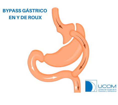 Roux En Y Bypass Gastrico Ramo Aferente Bariatric Surgery Procedures