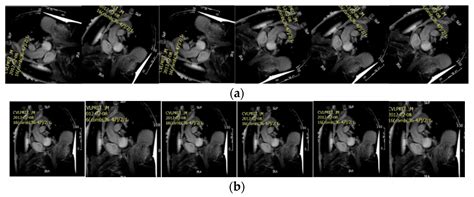 Myi Net Fully Automatic Detection And Quantification Of Myocardial Infarction From