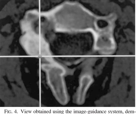 Frameless Fractionated Stereotactic Radiation Therapy Semantic Scholar