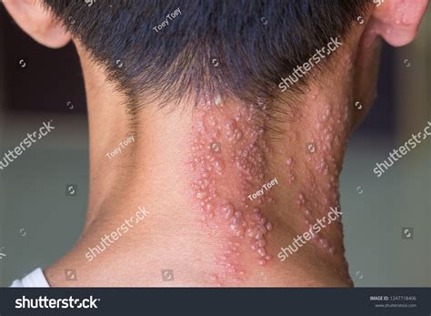 Herpes Simplex On Neck