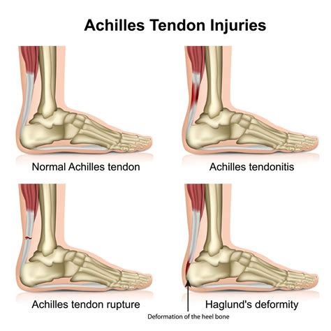 Injury Of The Week Achilles Tendon Symmetry Physiotherapy