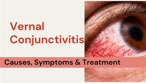 Vernal Conjunctivitis Causes Symptoms And Treatment Laxmi Eye Hospital